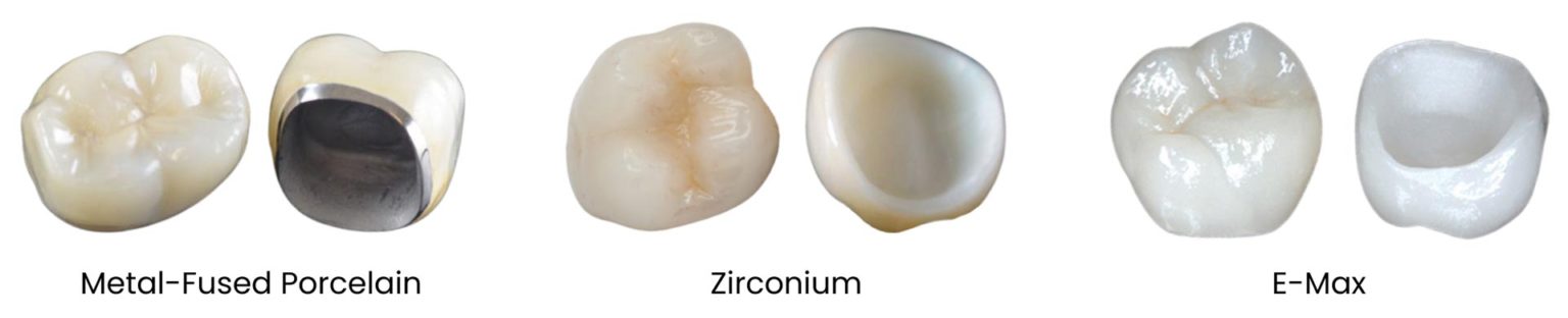 Crowns x Veneers: What Is the Difference? - Antalya Dent Smile