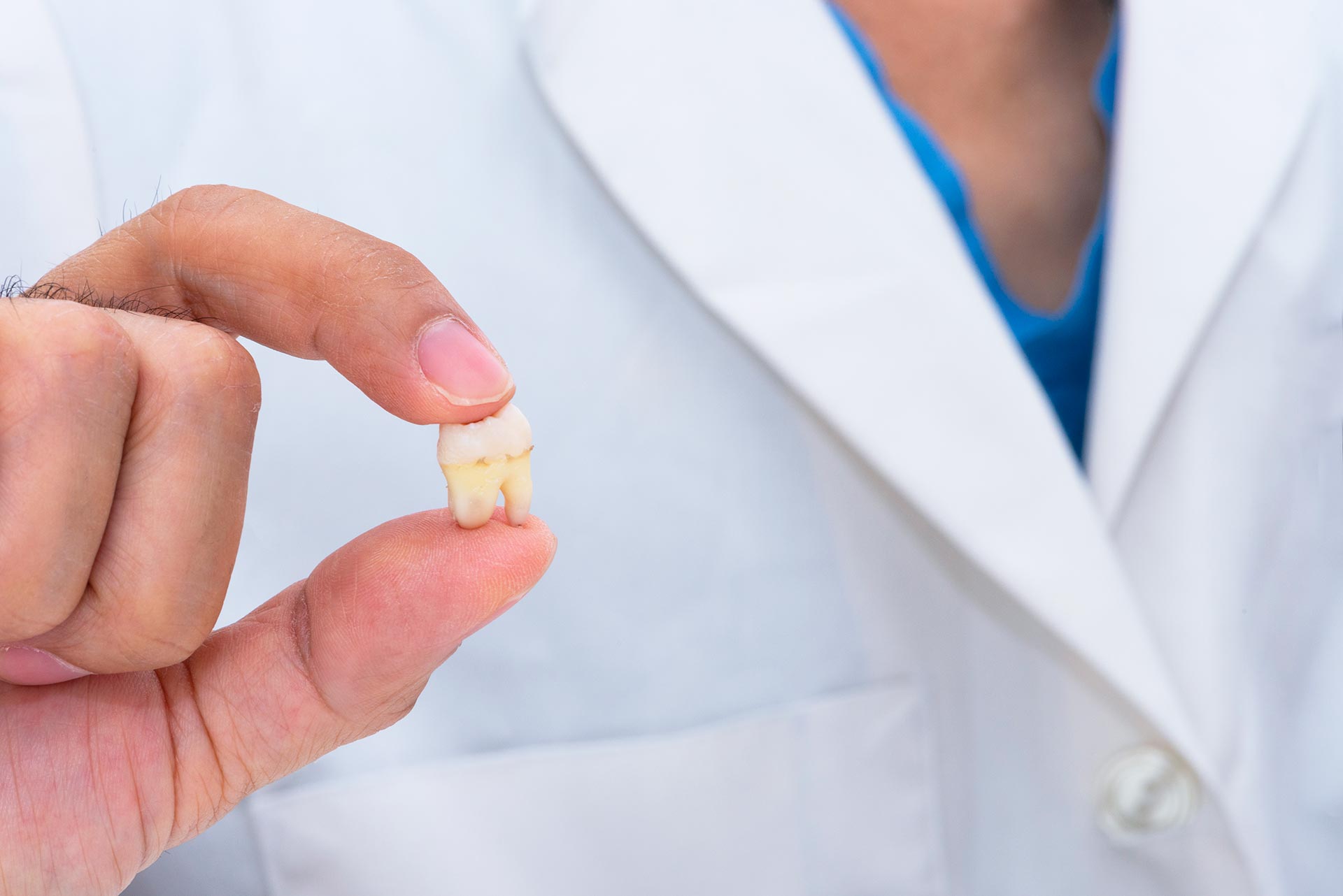 What Are Wisdom Teeth and Why Are They Removed? - Antalya Dent Smile