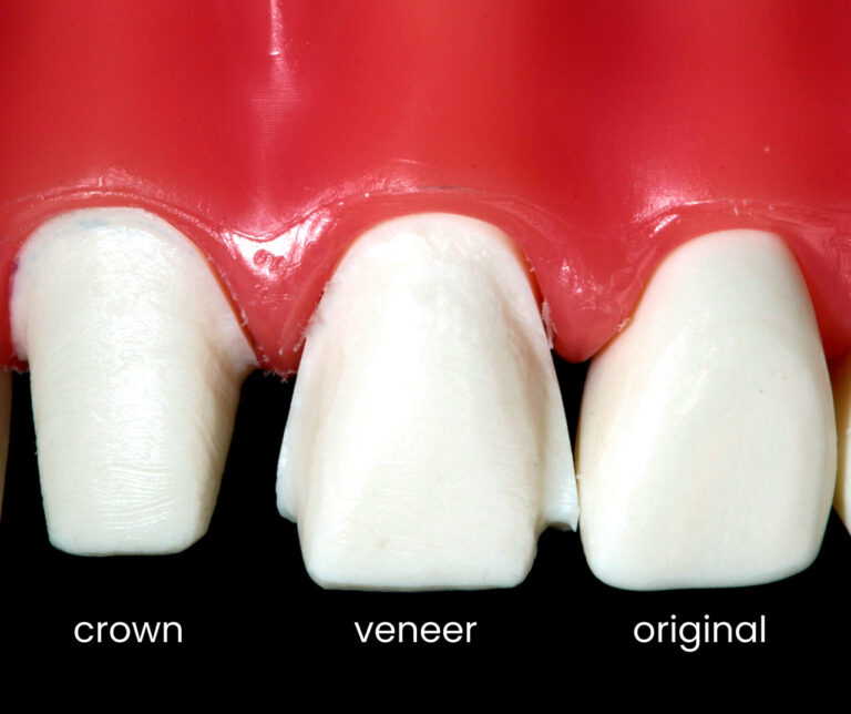 Crowns x Veneers: What Is the Difference? - Antalya Dent Smile