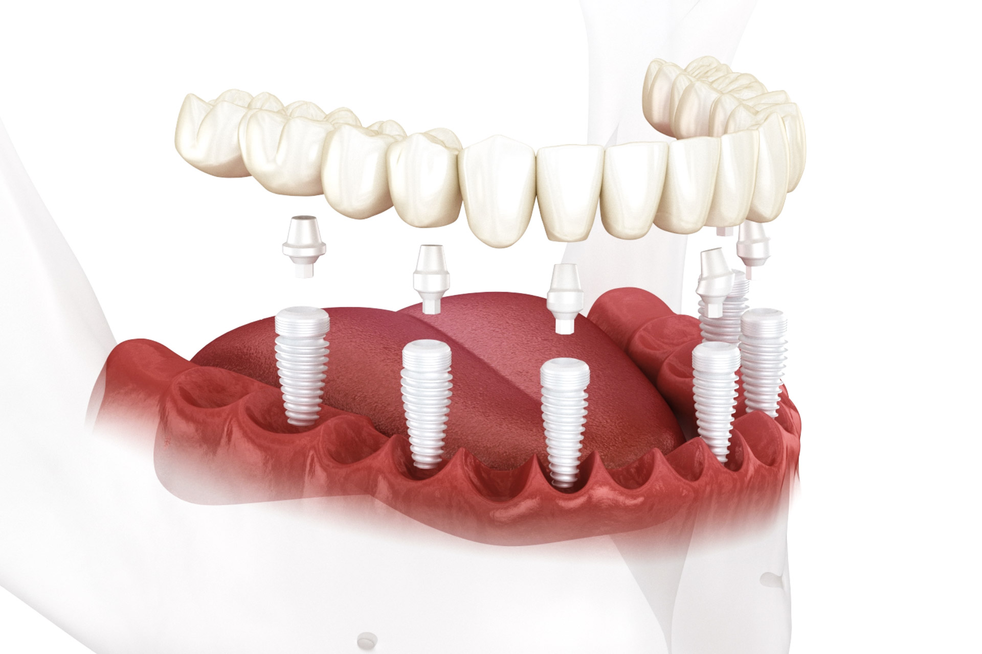 Dental Implants Made Of Zirconium at Russell Hixson blog
