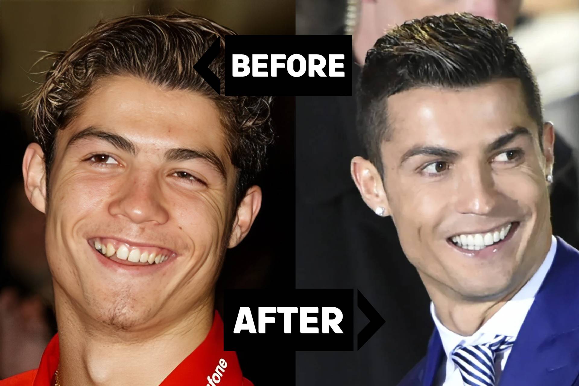 Ronaldo Teeth