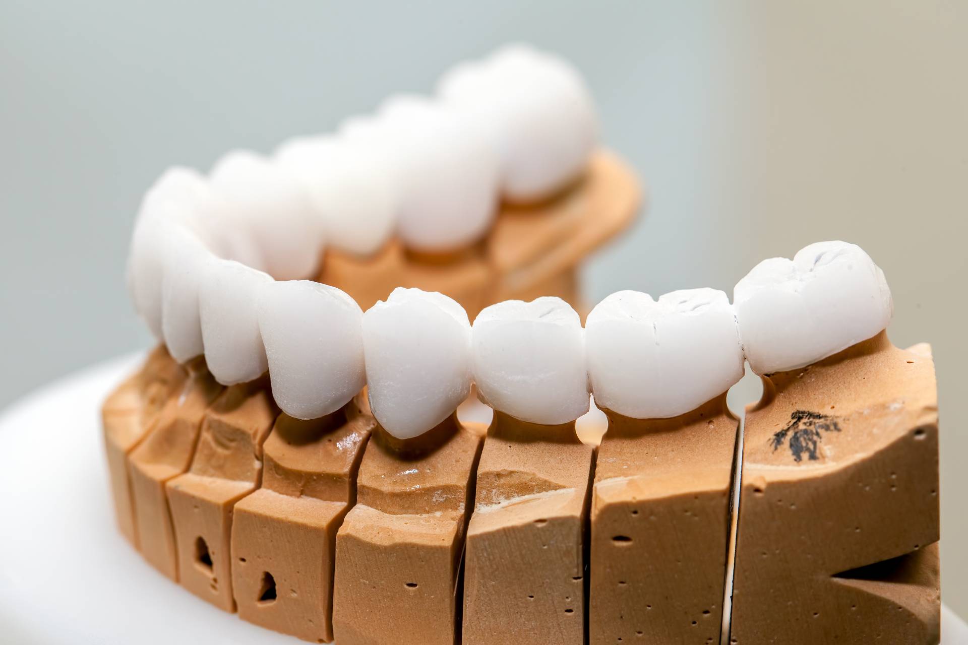 Are Porcelain Fused to Metal (PFM) Crowns Still Safe to Use? - Antalya ...