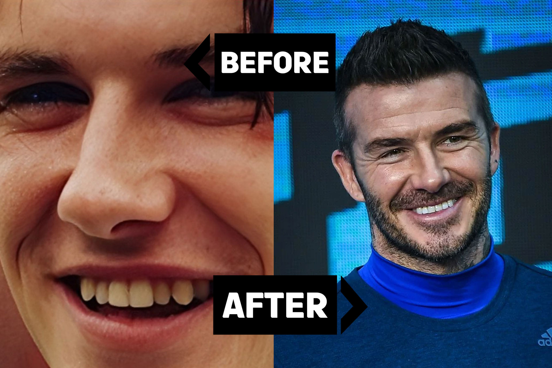 The David Backham Wave in Modern Dental Aesthetics - Antalya Dent Smile