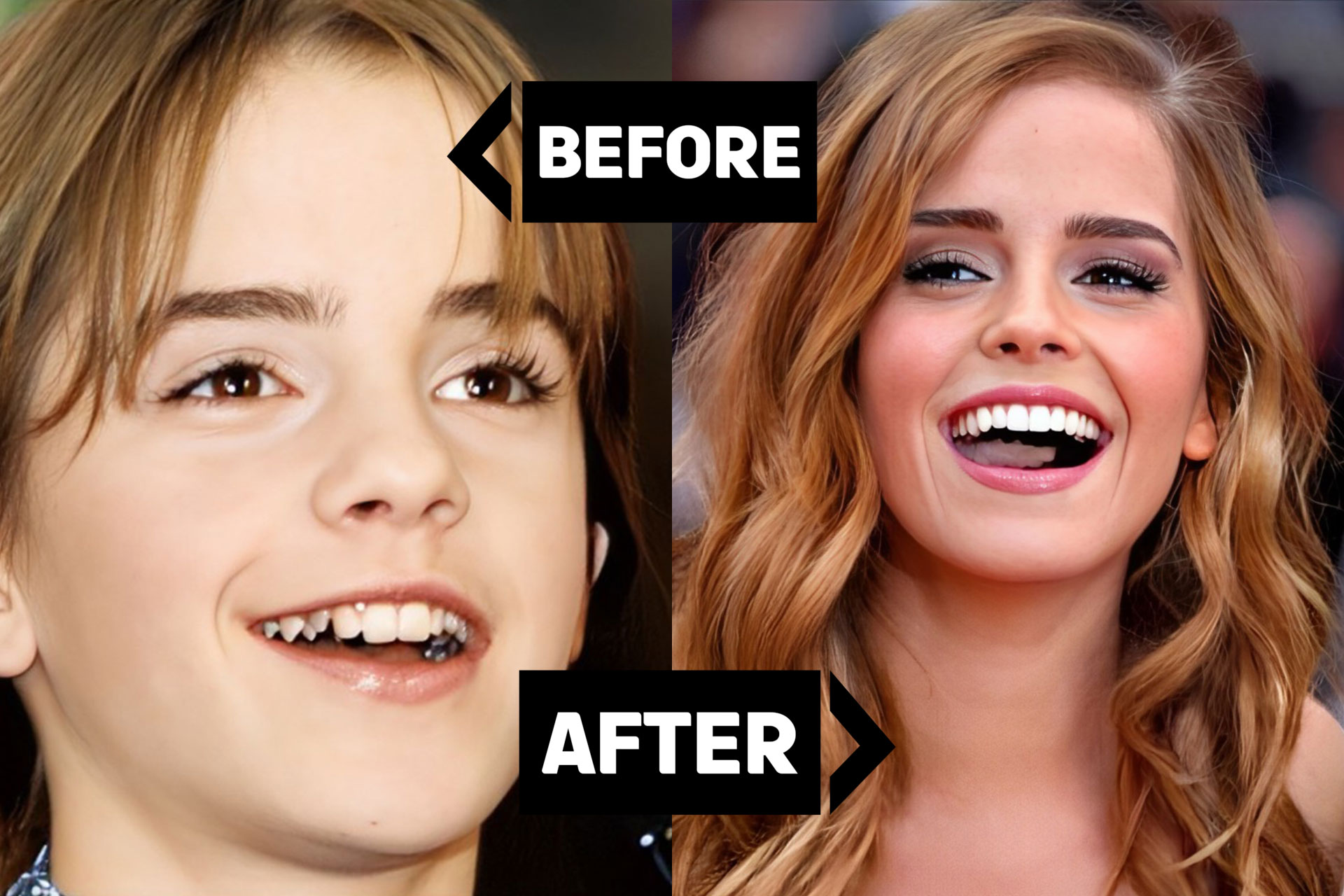 Emma Watson's Magical Smile Makeover Treatment - Antalya Dent Smile