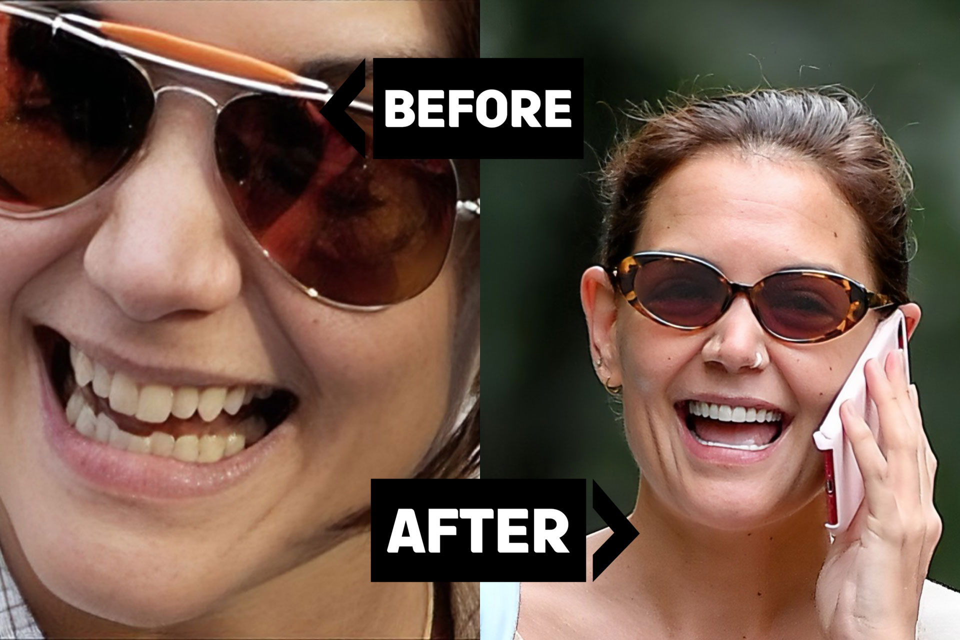 Katie Holmes Dentes Antes E Depois Cosmetic Dermatology & Surgery