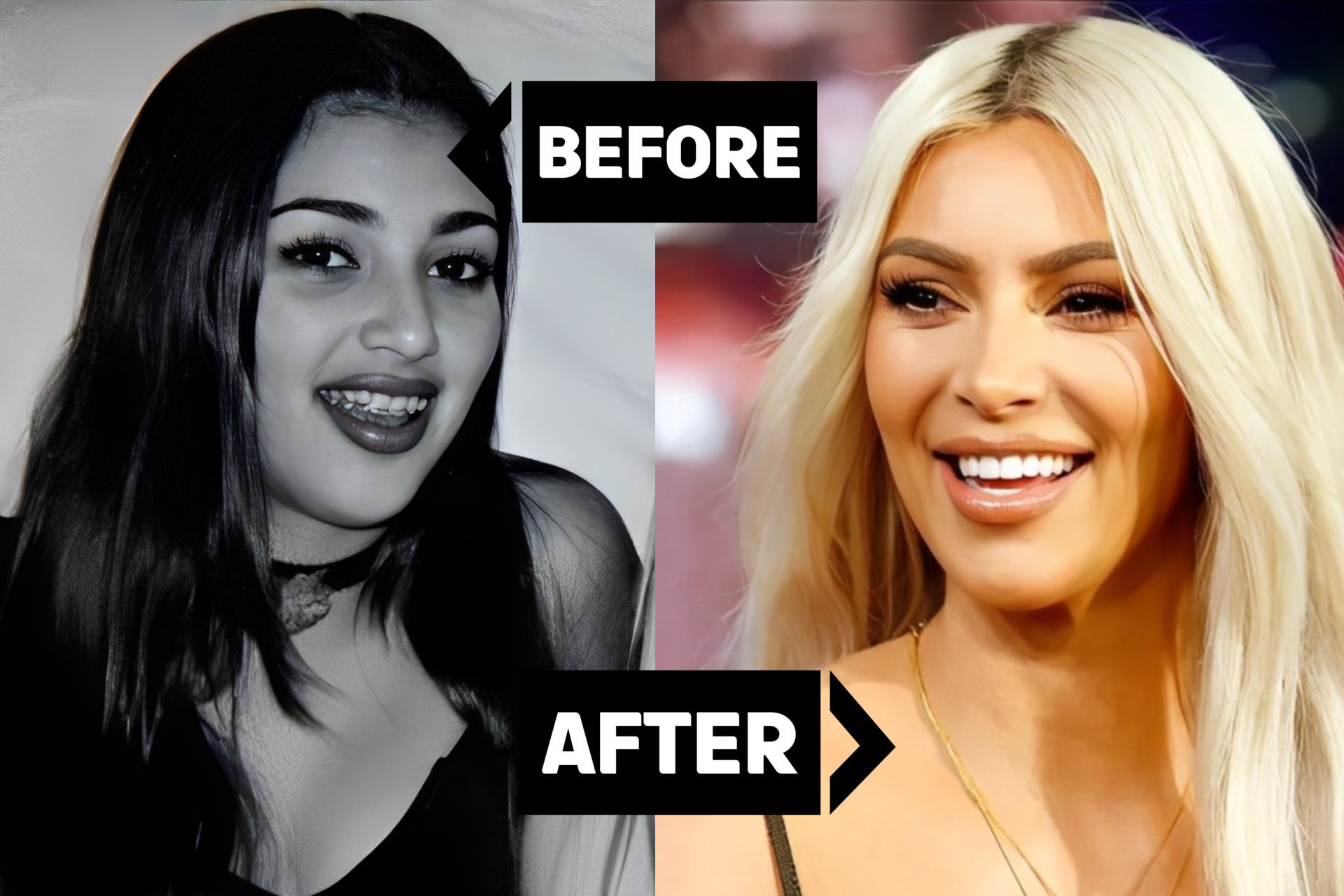 Kim Kardashian's Phased Tooth Transformation - Antalya Dent Smile